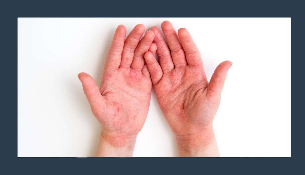 Safeguard Your Hands: Remedies for Skin Allergies and Irritations